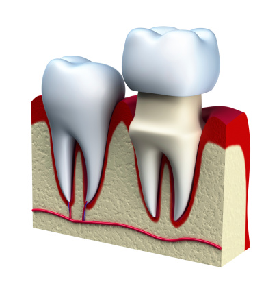 What Are the Main Differences Between Crowns & Bridges? | Northside ...